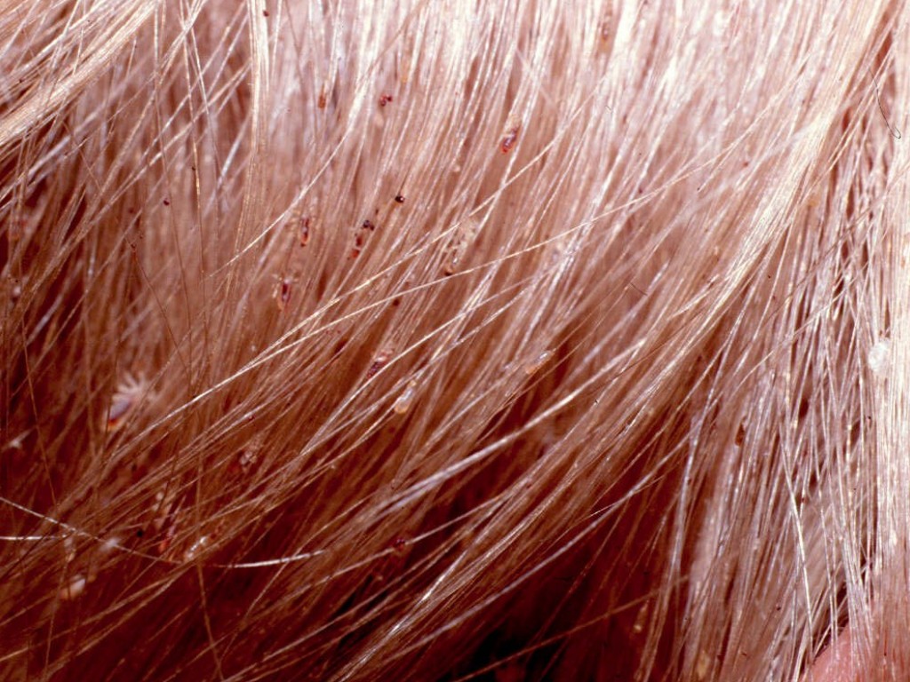 Luizen In Blond Haar Stockfoto's Van Pediculosis, Rechtenvrije